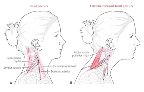 Can Poor Posture Cause Headaches? - Connection