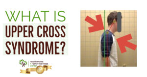 What Is Upper Crossed Syndrome?