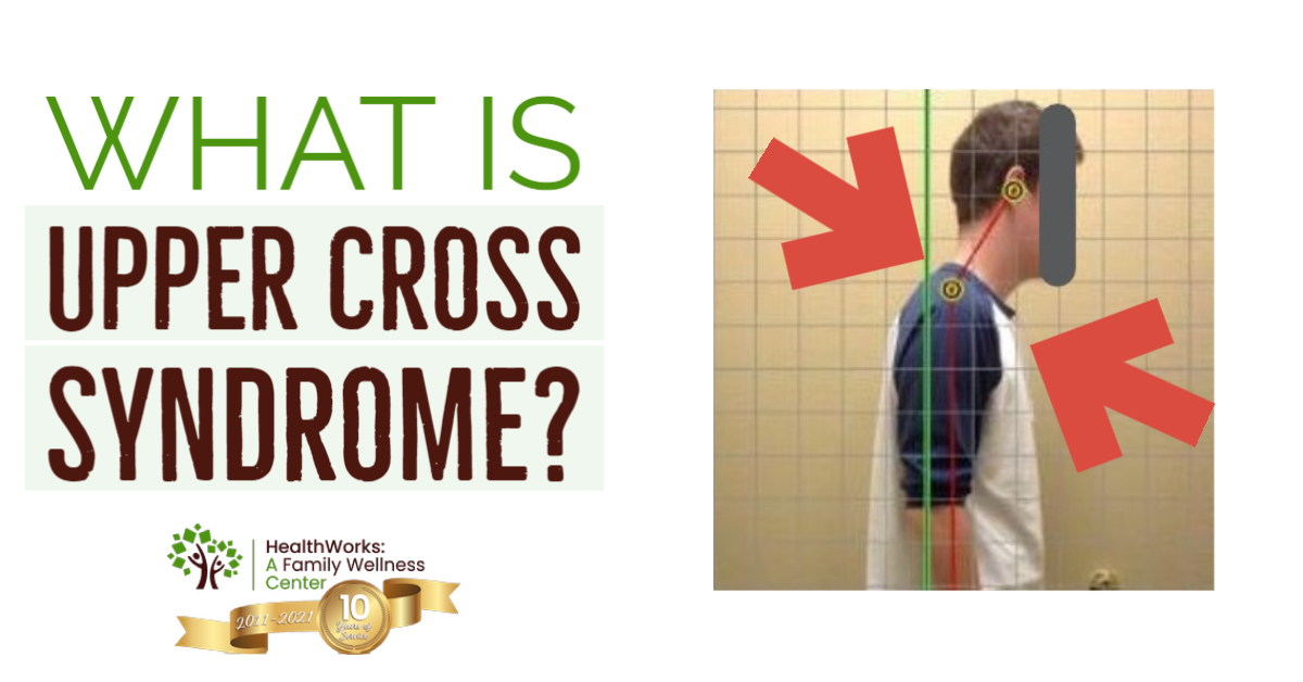 Vladimir Janda Upper Cross Syndrome Dr. Bryon's Health Blog: Upper